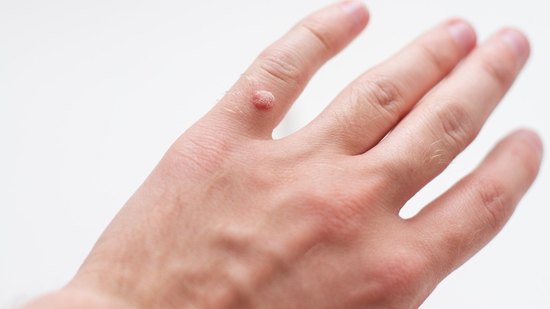 How to remove a mole safely? - Dr. Sebastian Podlipnik