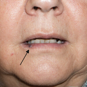 Red moles, angiomas or red spots on the skin - How to remove them?