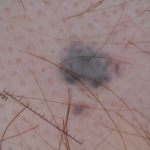 Blue nevus - Do I need to worry if I have a blue mole on my skin?