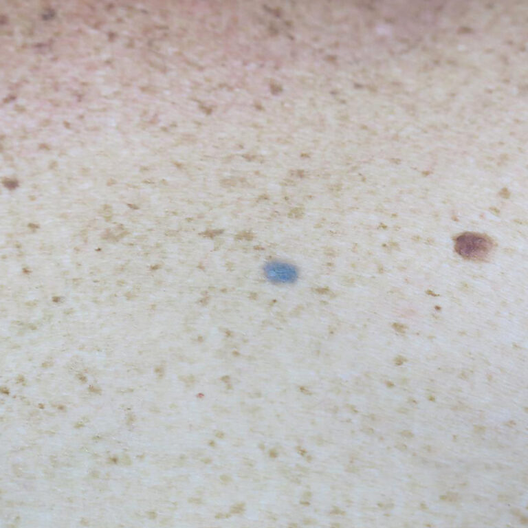 Blue nevus - Do I need to worry if I have a blue mole on my skin?