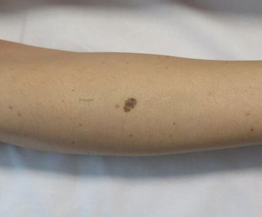 Lunares malignos o melanoma ¿Cómo identificarlos y tratarlos?