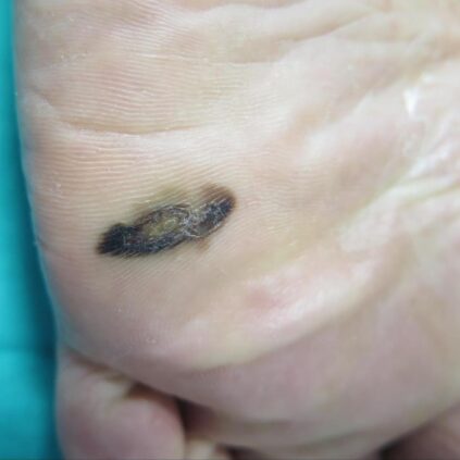 Lunares malignos o melanoma ¿Cómo identificarlos y tratarlos?