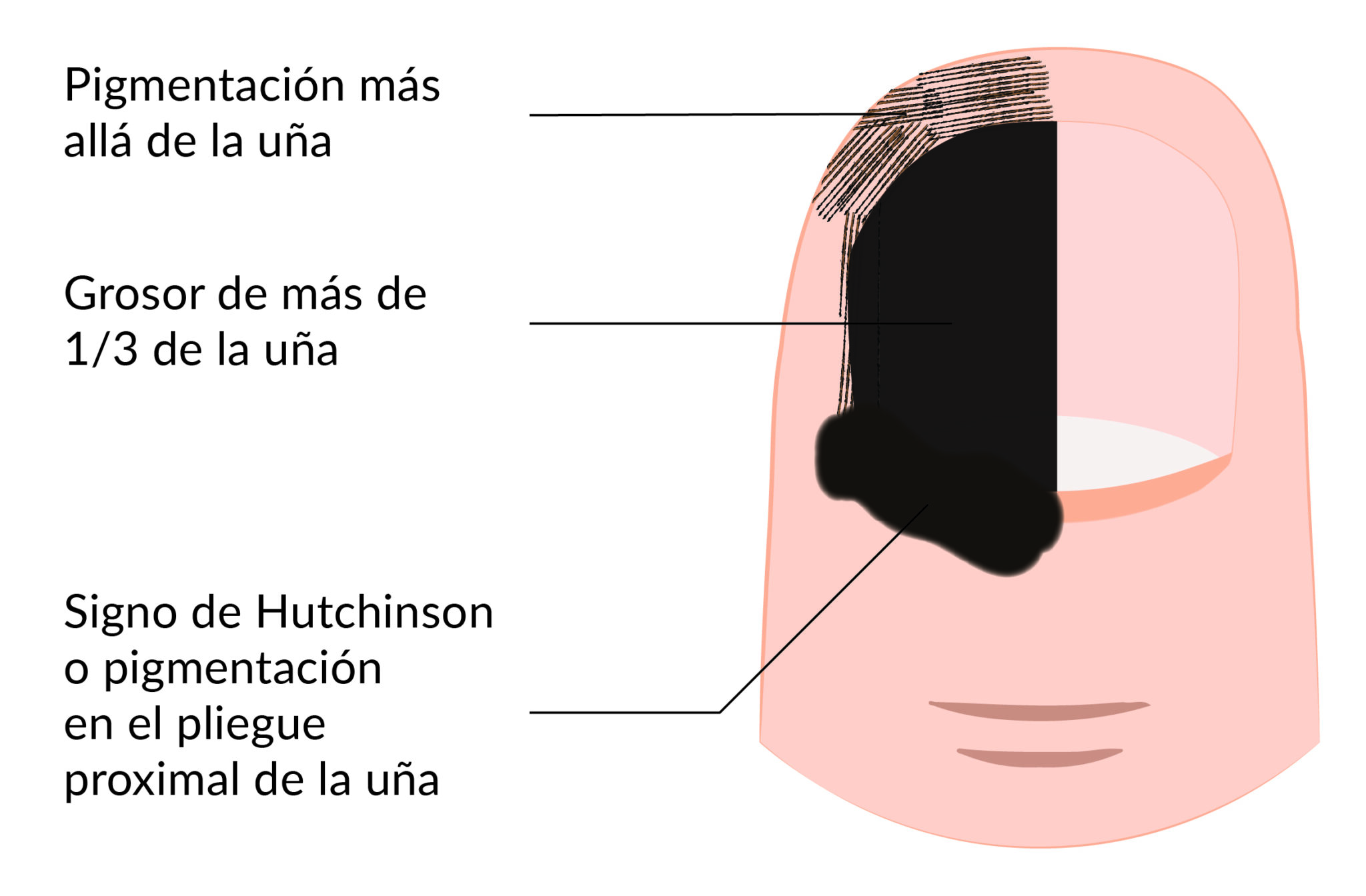 Melanoniquia: lunares y melanoma en la uña - Dr. Podlipnik