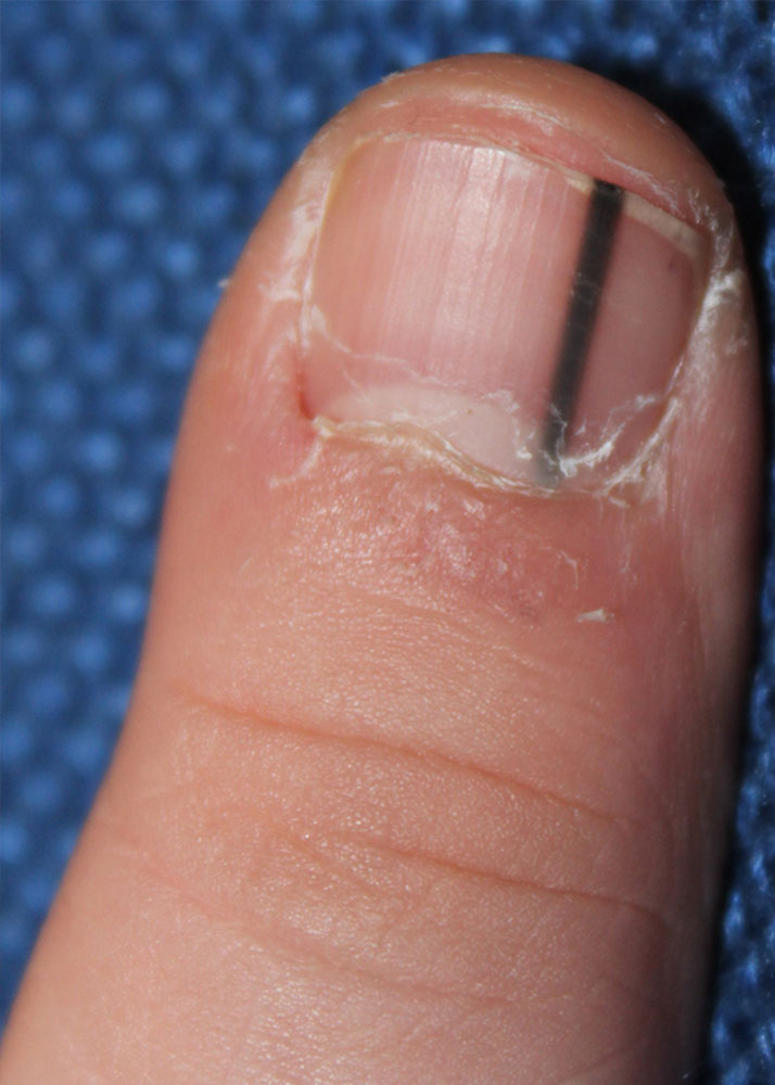 Lunares y melanoma en la uña. ¿Cómo identificarlos? - Dr. Sebastian ...