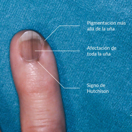 Lunares y melanoma en la uña. ¿Cómo identificarlos? - Dr. Sebastian ...