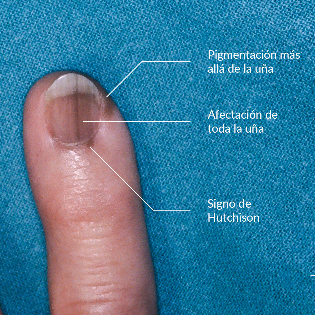 Lunares y melanoma en la uña. ¿Cómo identificarlos? - Dr. Sebastian ...