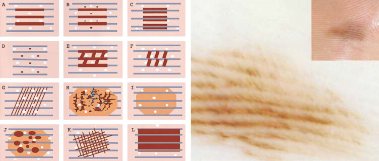 Moles on the soles of the feet and palms of the hands