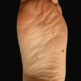 Moles on the soles of the feet and palms of the hands