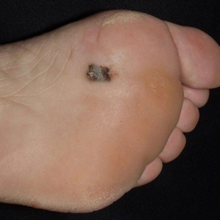 Moles on the soles of the feet and palms of the hands