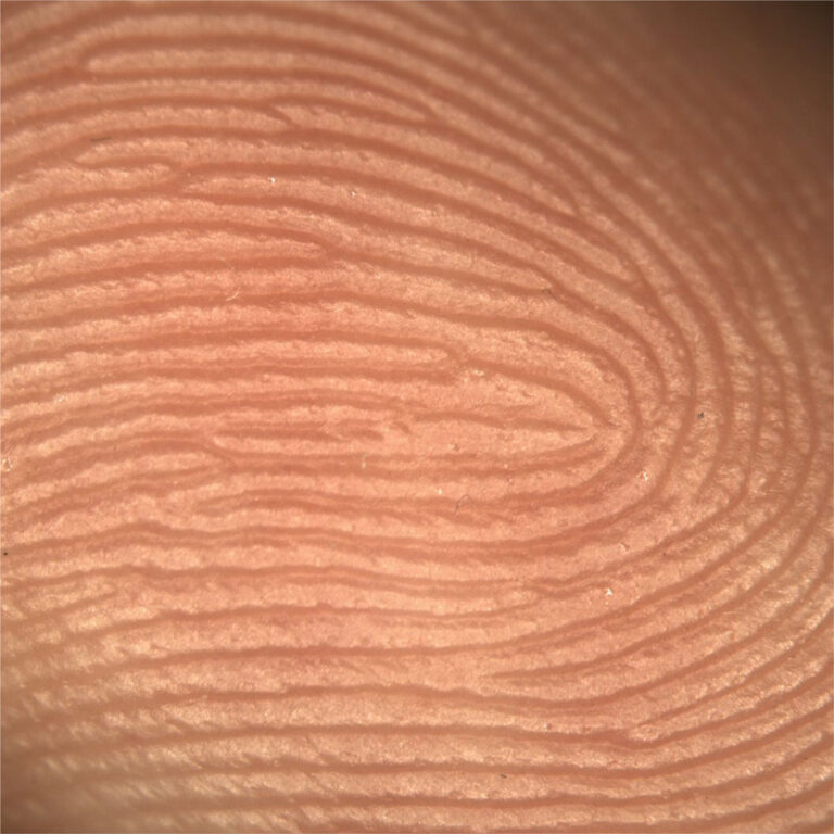 Moles on the soles of the feet and palms of the hands