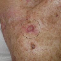 Cutaneous Horn: What It Is, Why It Forms, and How to Treat It
